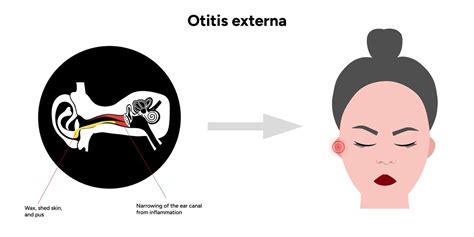 Premium Vector Otitis Externa Anatomy Ear Disease Inflammation