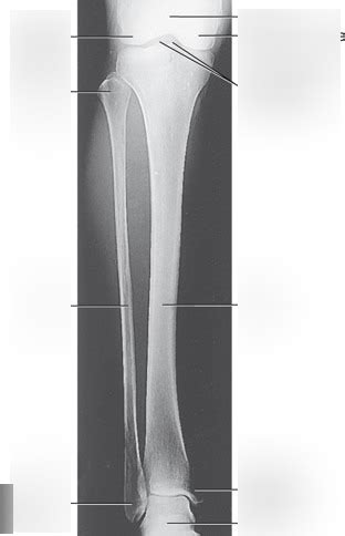 Tib Fib Diagram Quizlet