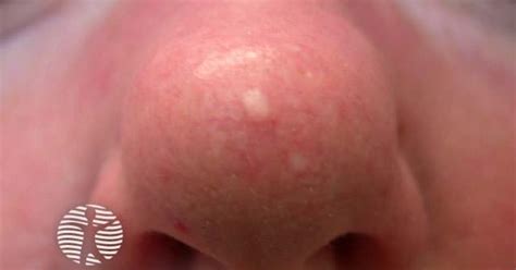 Fibrous Papule Image