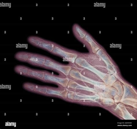 Osteoid Osteoma Coloured X Ray Of An Osteoid Osteoma White Centre