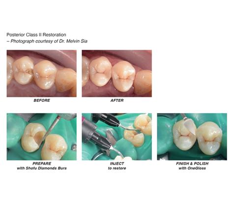 Shofu Beautifil Injectable X Nano Hybrid Composite Dandal Composite