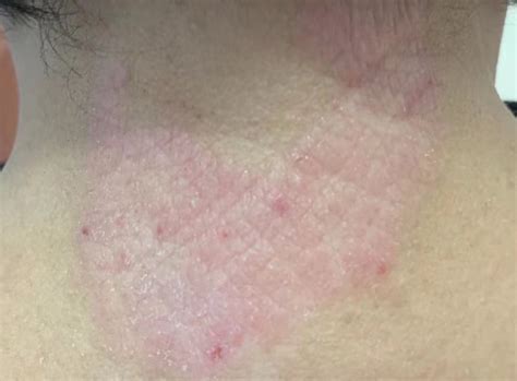 Lichen Simplex Skin Disease Lichen Simplex Chronicus Neurodermatitis