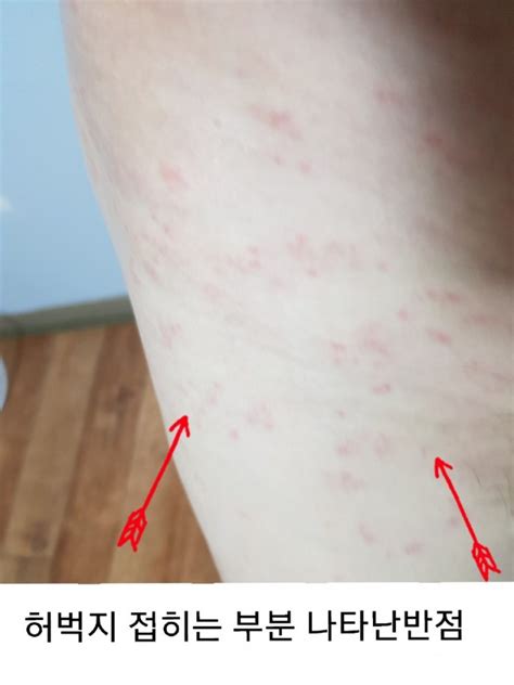 몸에 생긴 붉은 반점 접촉성피부염 열꽃 같은 피부 땀띠 네이버 블로그