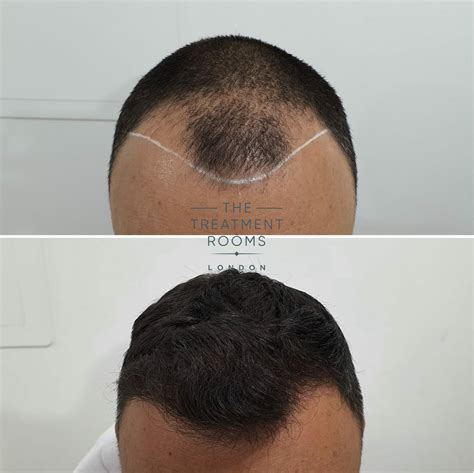 Hair Transplant Clinic Uk Book With Treatment Rooms London
