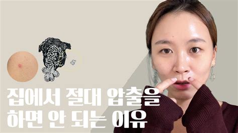 여드름 압출 절대 짜면 안 되는 여드름 관리법 Youtube