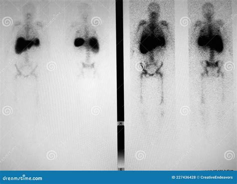 How Is An Indium Scan Of The Body Done Ebnc