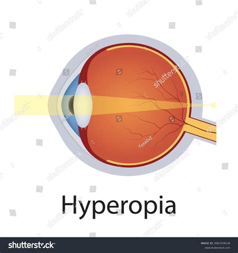 Hyperopia Vision Disorders Illustration Eyes Defect Stock Vector