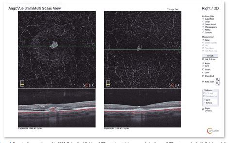 Figure 4 From Choroidal Neovascularization Secondary To Acute Retinal