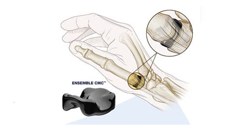 Ensemble Orthopedics Th Implantation Of Interpositional CMC
