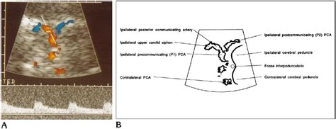 A Cross Flow Through The PCoA To The P1 Segment Of The PCA Is Shown Download Scientific
