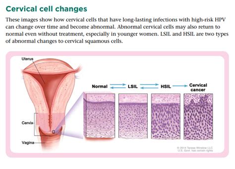 Cervical Cancer