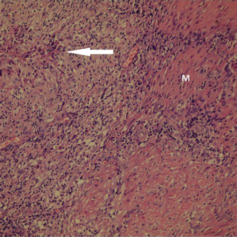 Scapulothoracic Injection At The Medial Border Of The Scapula The Limb