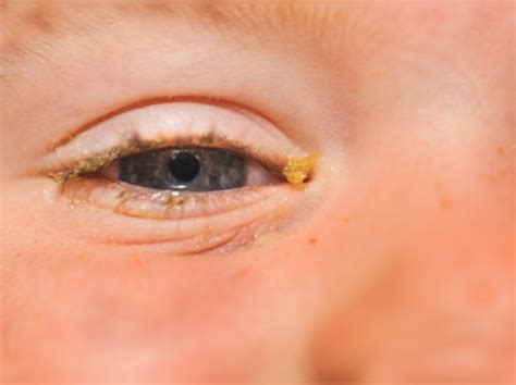 What Is That Gunk In Your Eyes In The Morning Times Of India