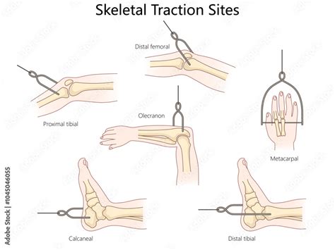 Skeletal Traction Sites On The Human Body Including Proximal Tibial Calcaneal And Metacarpal