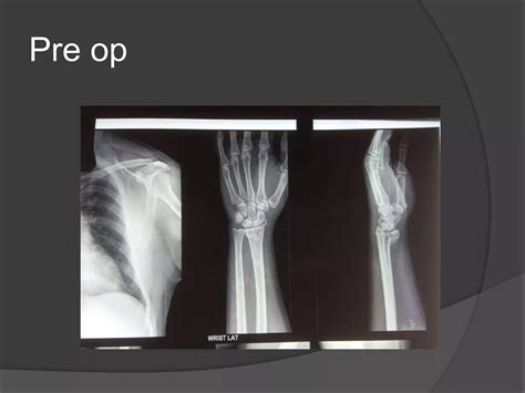 Distal End Radius Fractures Management Ppt