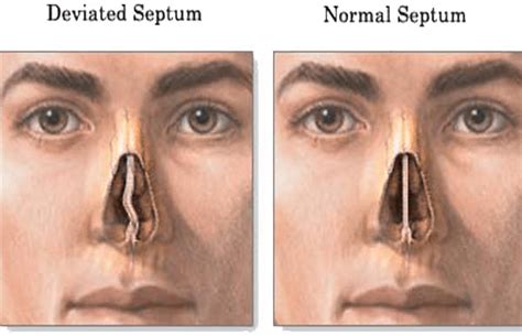 How To Cure A Deviated Septum Treatmentstop21