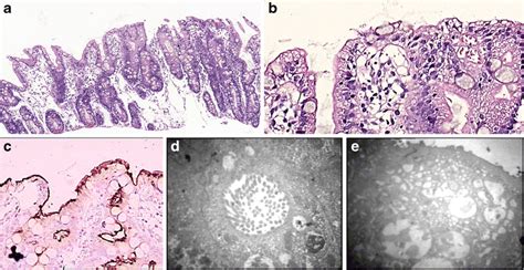 A Duodenal Mucosa Of A Newborn Showing Villous Atrophy Crypt