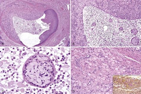 12 Inflammatory Salivary Gland Disorders Pocket Dentistry