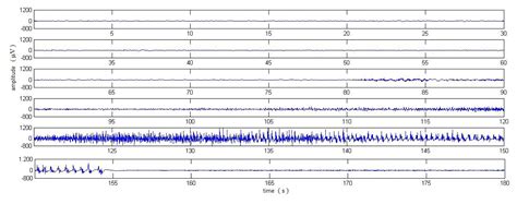 Tonic Clonic Seizure Eeg