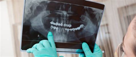 What You Need To Know About Dental Extractions