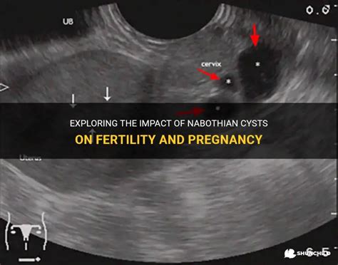 Exploring The Impact Of Nabothian Cysts On Fertility And Pregnancy