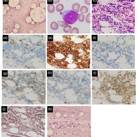 A B Bone Marrow Smear During The Initial Examination Cj Bone