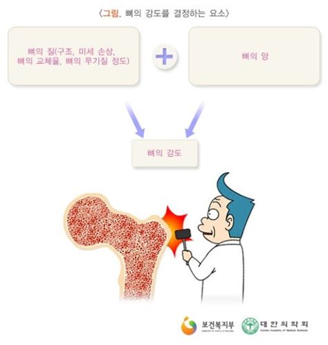 골다공증에 좋은 음식 골다공증의 원인~~
