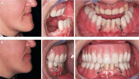 A Intraoral And Extraoral View Of The Maxillary Orpd And The Download Scientific Diagram