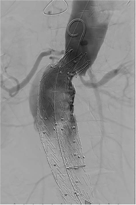 Coil Embolization Of Persistent Type 1 Endoleak Journal Of Vascular