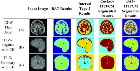 Segmentation Of Meningioma In The Brain Of A Patient Of Age 35 Download Scientific Diagram
