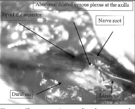 Figure 1 From Abnormal Dilated Epidural Venous Plexus Mimicking Prolapse Of Intervertebral