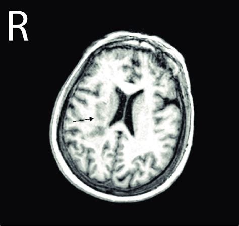 Cranial Magnetic Resonance Axial Section In Sequence Standardized T1