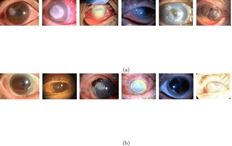 Automated Eye Disease Classification Method From Anterior Eye Image