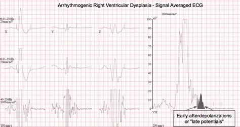 Signal Averaged Ecg Saecg