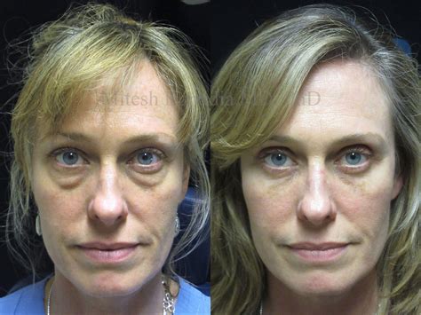 Upper And Lower Eyelid Surgery Before And After Photos You