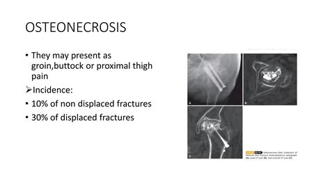 Intracapsular Fracture Neck Of Femur Pptx