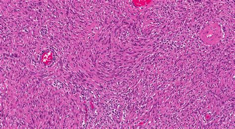 What Is A Spindle Cell Neoplasm Mypathologyreport