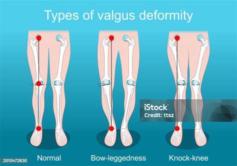 Valgus Deformities Knee Deformity Corrective Surgery Stock Illustration Download Image Now
