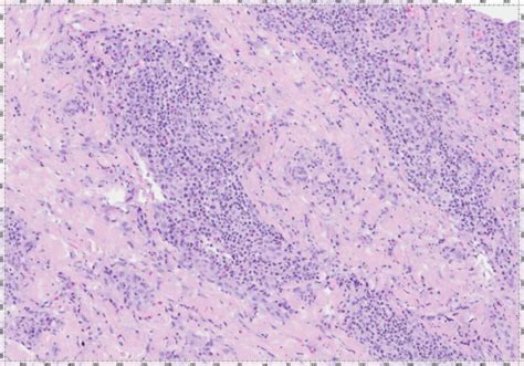 Inflammatory Cell Infiltrate With Lymphocytes Histiocytes