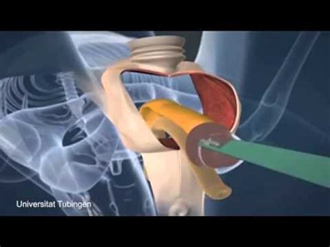 The Surgical Process For Male To Female Sex Reassignment YouTube