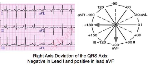 Determine Axis On A 12 Lead Ecg Tracing