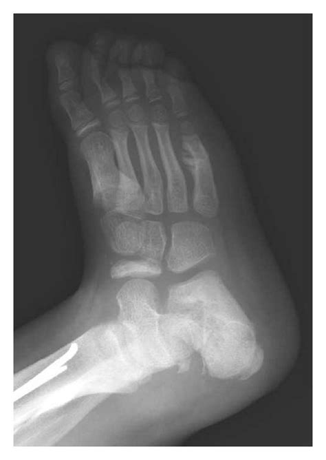 Navicular Avascular Necrosis And Fifth Metatarsal Fracture In The Right