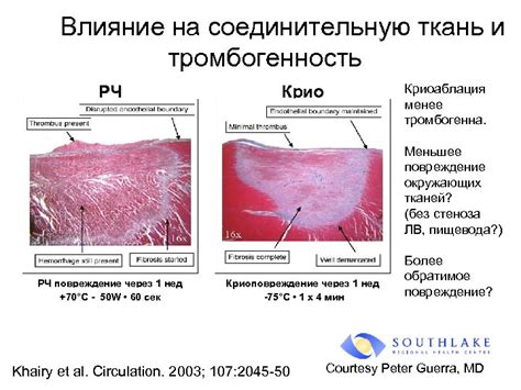Баллонная и петлевая катетерные аблации легочных вен Ishne