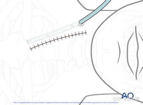 极简手术图谱前入路到达颈椎 知乎