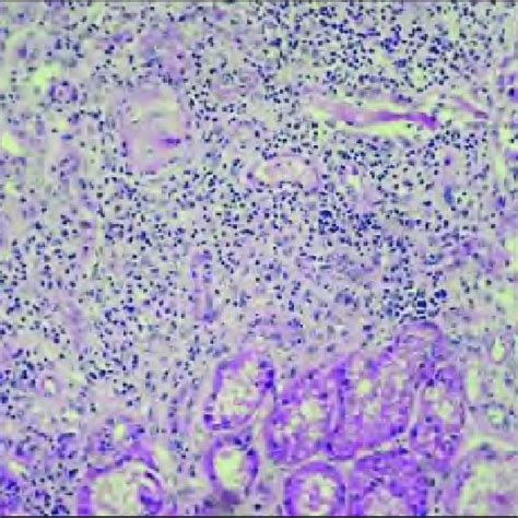Esclerosis Glomerular Atrofi A Tubular Y Nefritis Intersticial