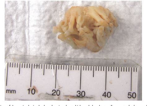 Figure 1 From Maroteaux Lamy Syndrome A Rare And Challenging Case Of