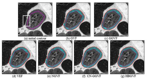 Image Segmentation Using Active Contours With Hessian Based Gradient Vector Flow External Force