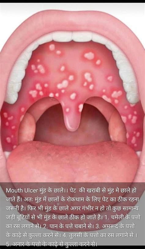 Aphthous Ulcers Aphthae In The Mouth Causes And Treatments Artofit