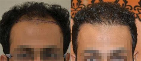 Mens Hair Transplant Results Male Hair Transplant Before After Photos DHI India