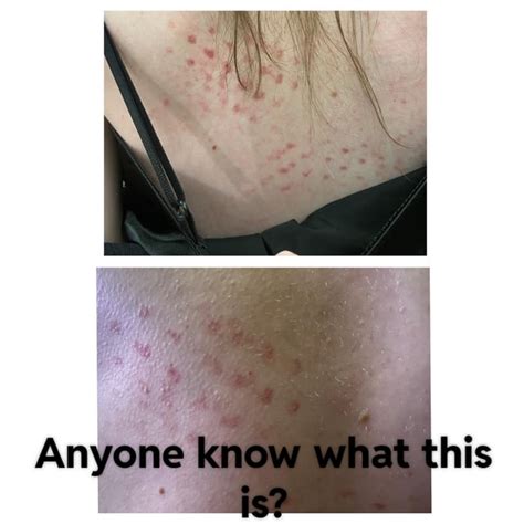 Red Grid Mark Rash R Skin